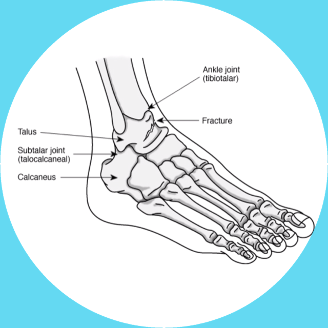 Talus Fractures | Tri-County Orthopedics